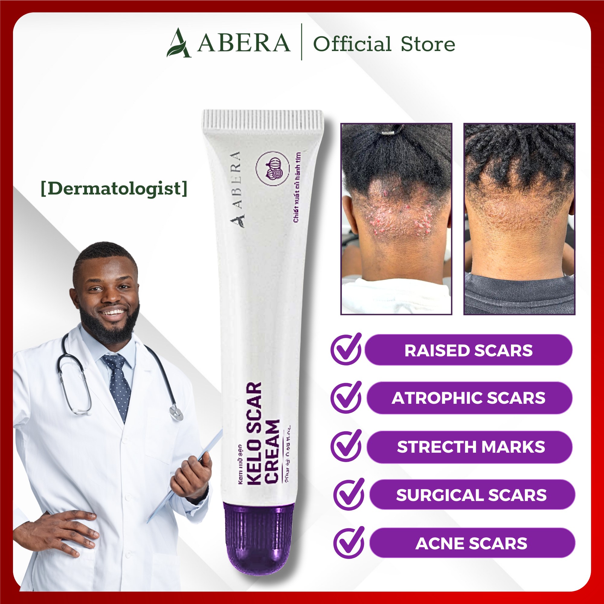 Abera Kelo Scar Cream - Authentic – ABERA US